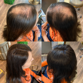 Hair Replacement Systems | Mesh Integration System | Angel Hair Extensions